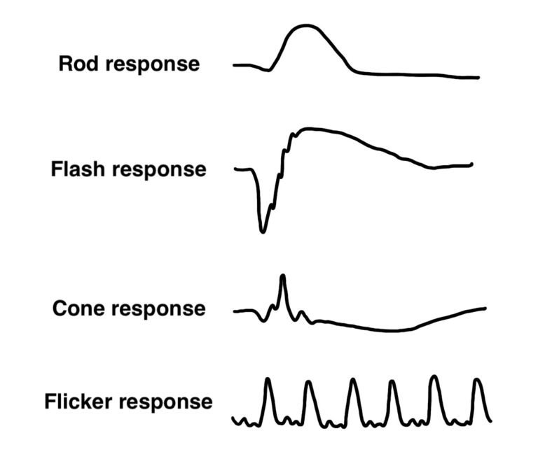 How to Read and Interpret ERG: A Practical Guide to Electroretinography ...