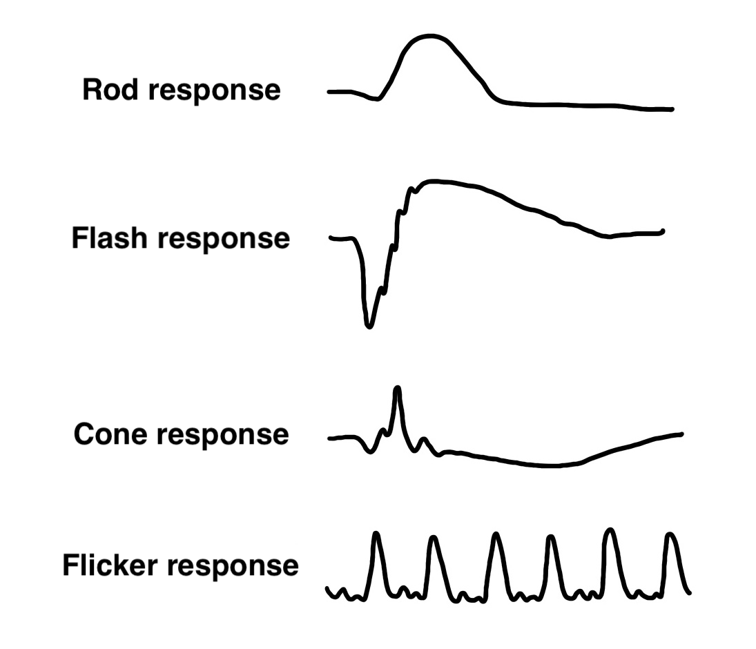 How to Read and Interpret ERG: A Practical Guide to Electroretinography ...