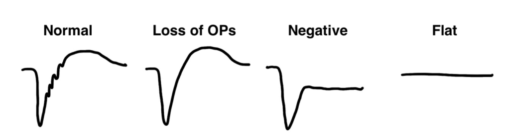 How to Read and Interpret ERG: A Practical Guide to Electroretinography ...