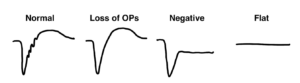 How to Read and Interpret ERG: A Practical Guide to Electroretinography ...